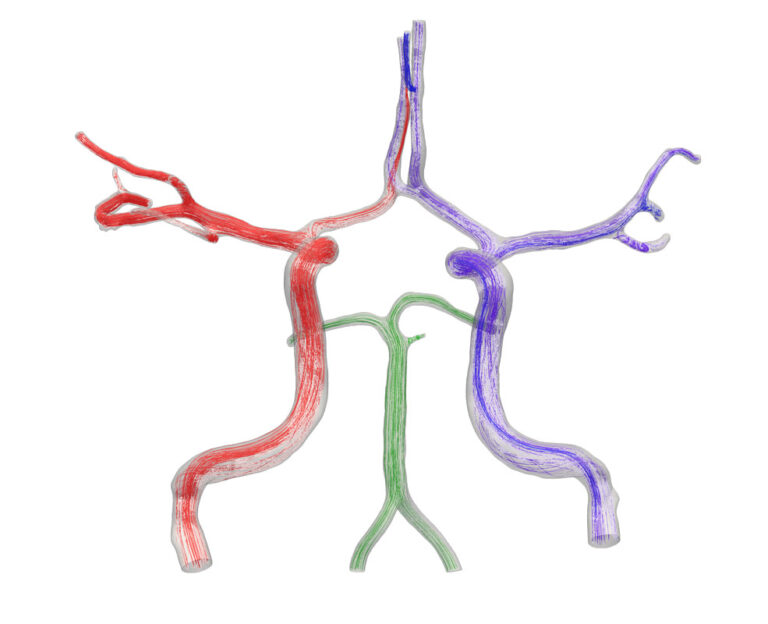 Stroke simulation – ELPIS Simulation Stroke simulation – ELPIS Simulation